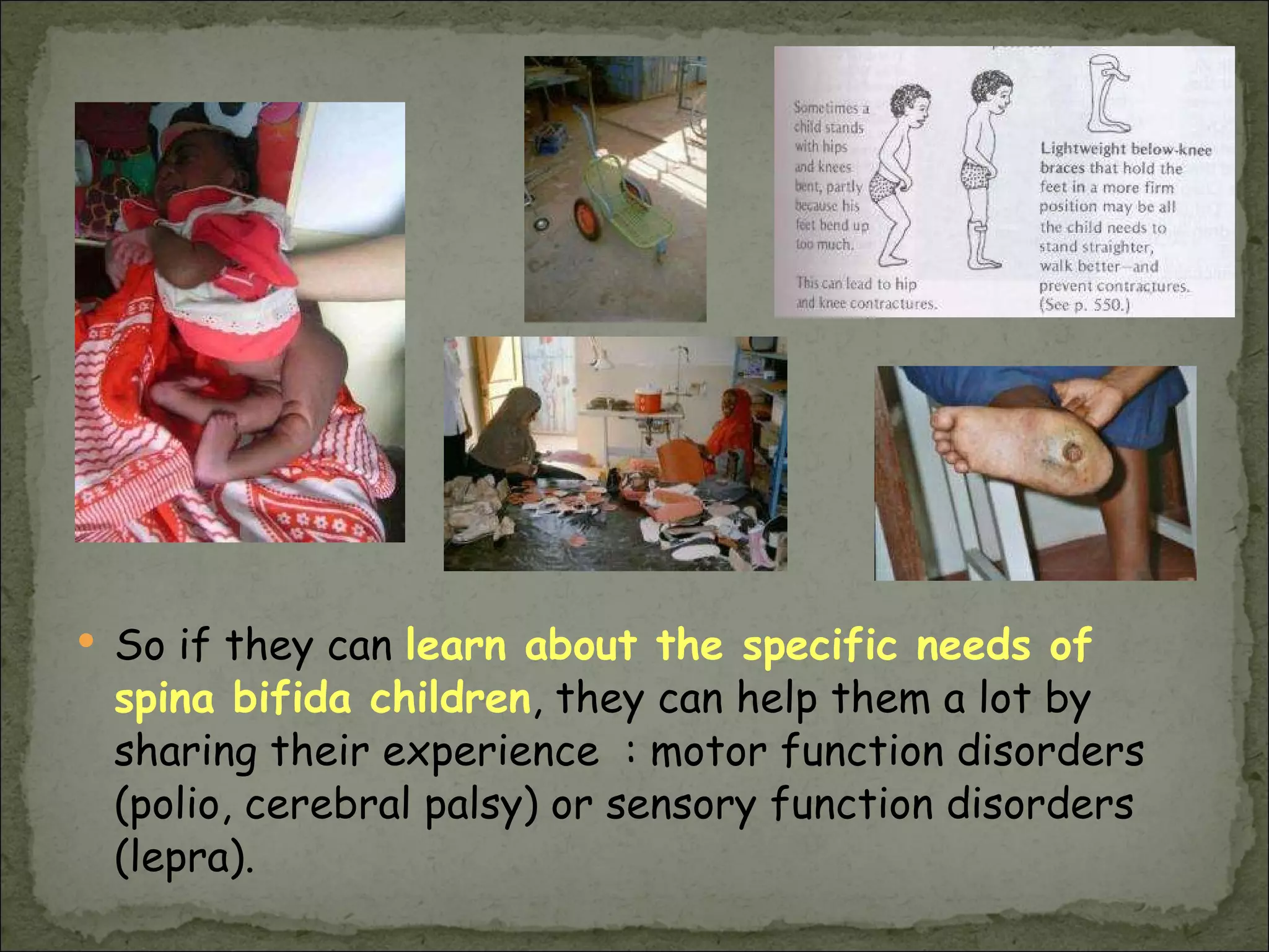 Living with spina bifida and hydrocephalus in developing countries ...