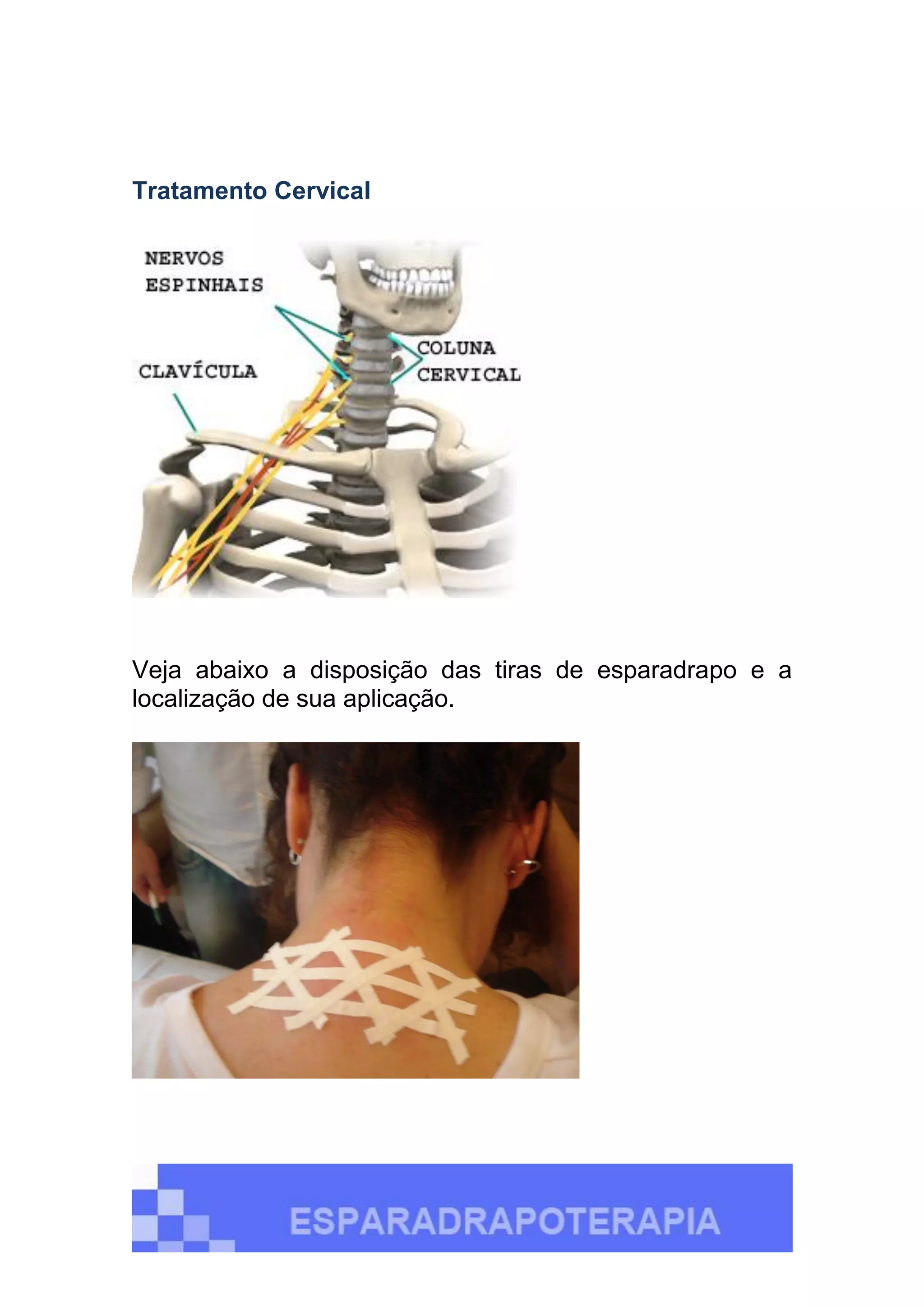 Spiral taping ou esparadrapoterapia | PDF