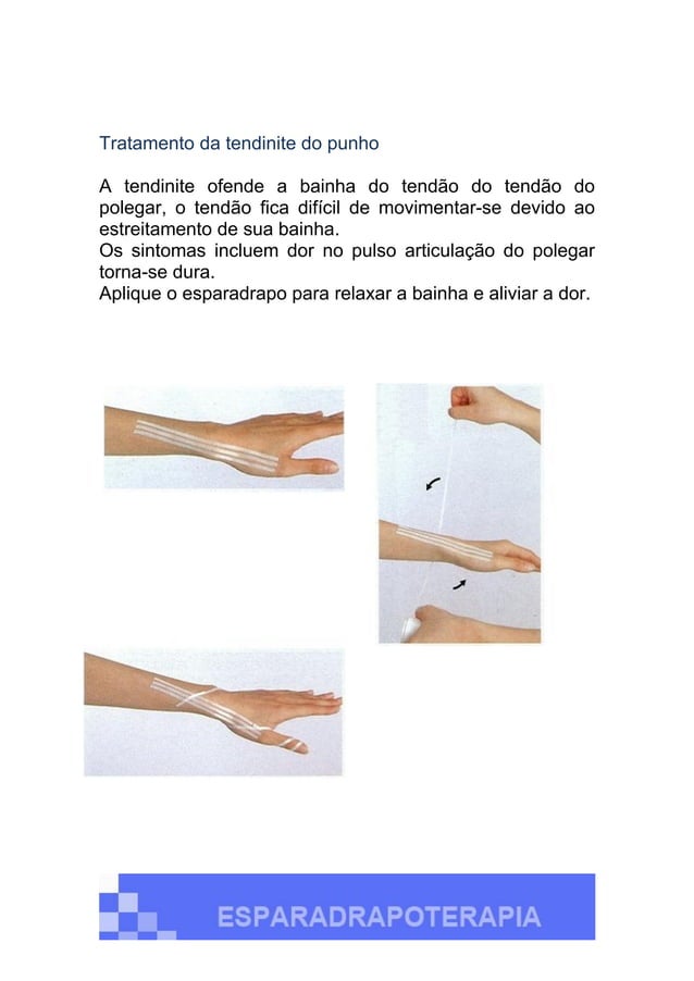 Spiral taping ou esparadrapoterapia | PDF