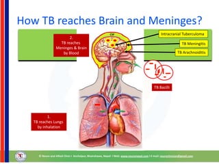 CNS Tuberculosis in developing countries | PPTX
