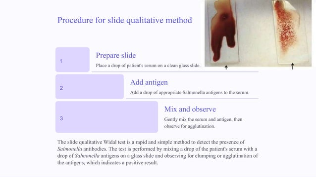 Widal Agglutination Test:A rapid serological diagnosis of typhoid fever ...