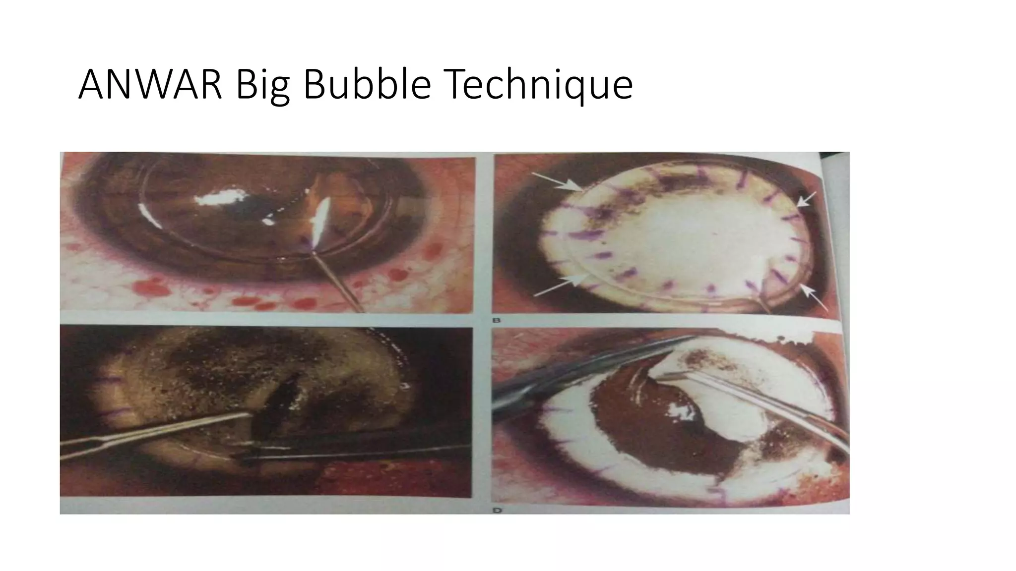 Lamellar Keratoplasty in ophthalmology | PPT