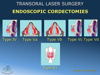 Endoscopic Surgery for Laryngeal Function Preservation by P. Nicolai | PDF