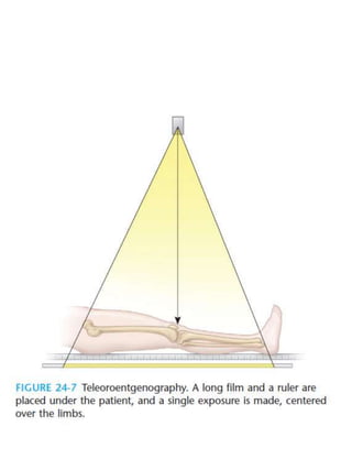 limb length discrepancy | PPTX