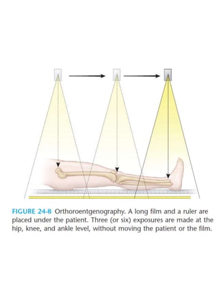 limb length discrepancy | PPTX