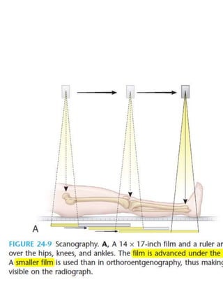 limb length discrepancy | PDF