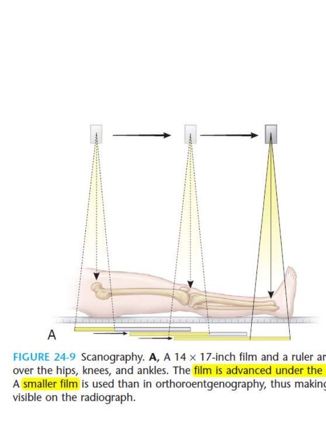 limb length discrepancy