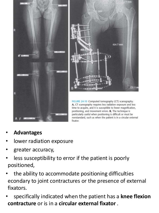 limb length discrepancy