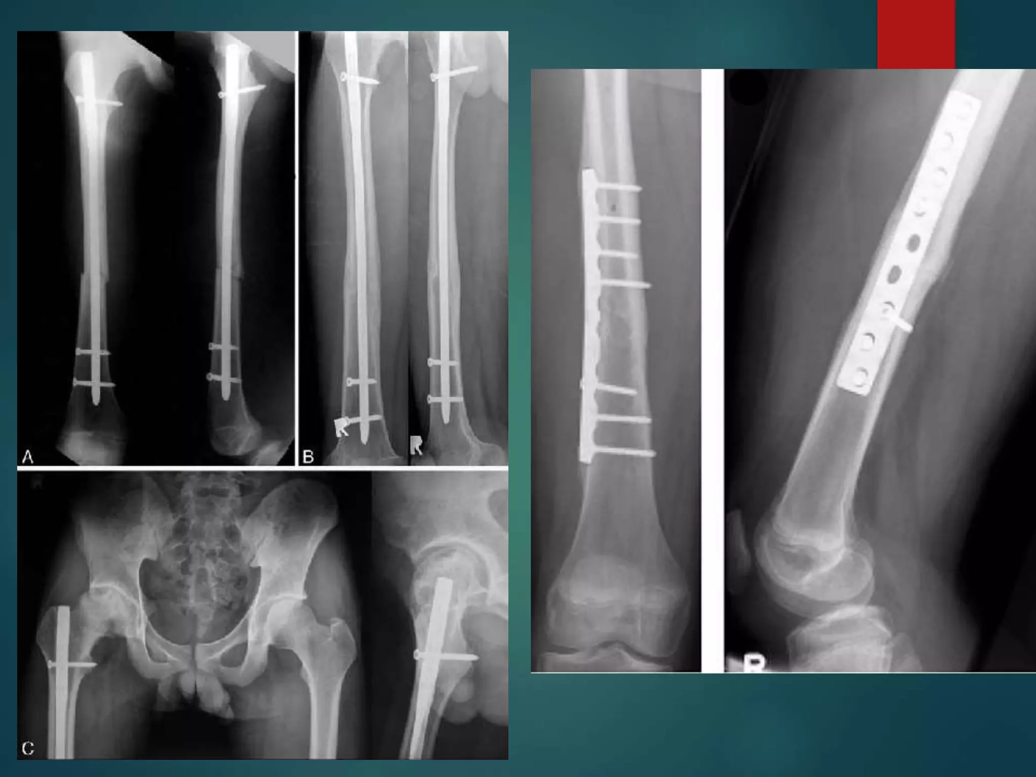 Lower Limb Fractures.pptx