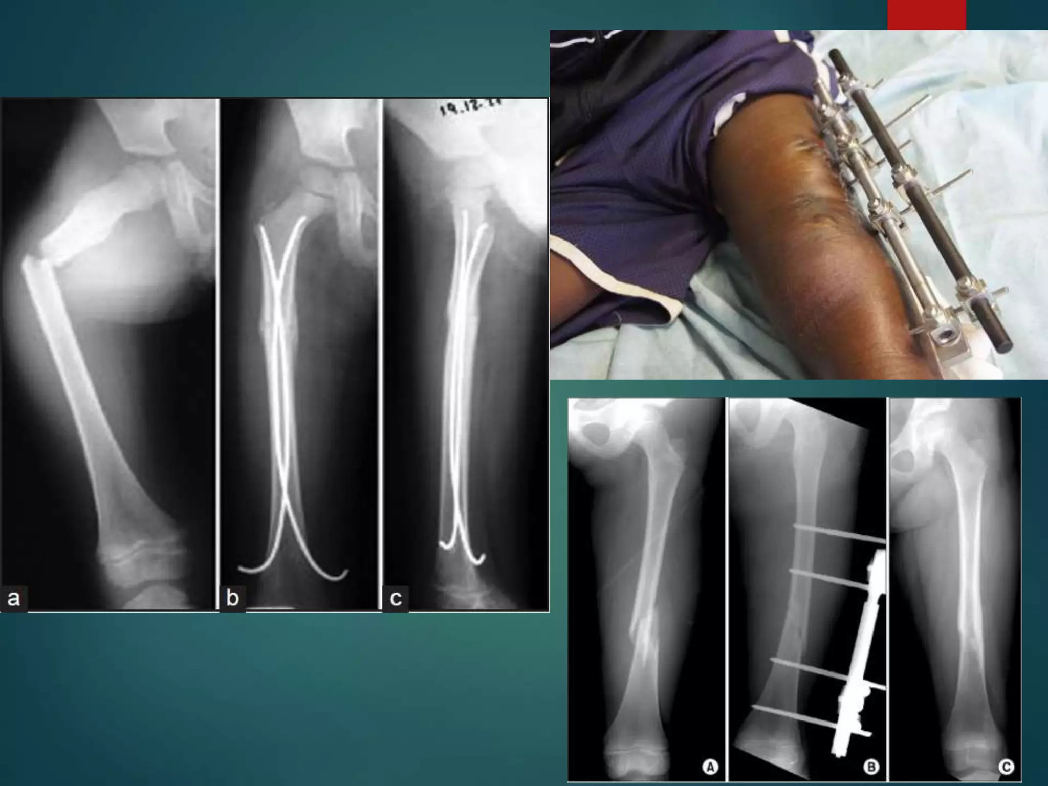 Lower Limb Fractures.pptx | Death, Injury, or Military Conflict ...