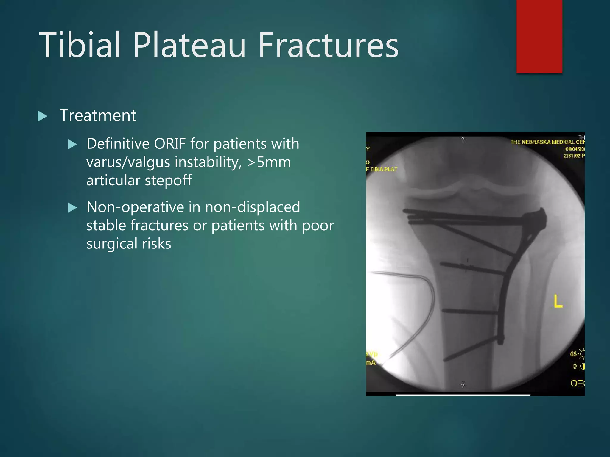 Lower Limb Fractures.pptx