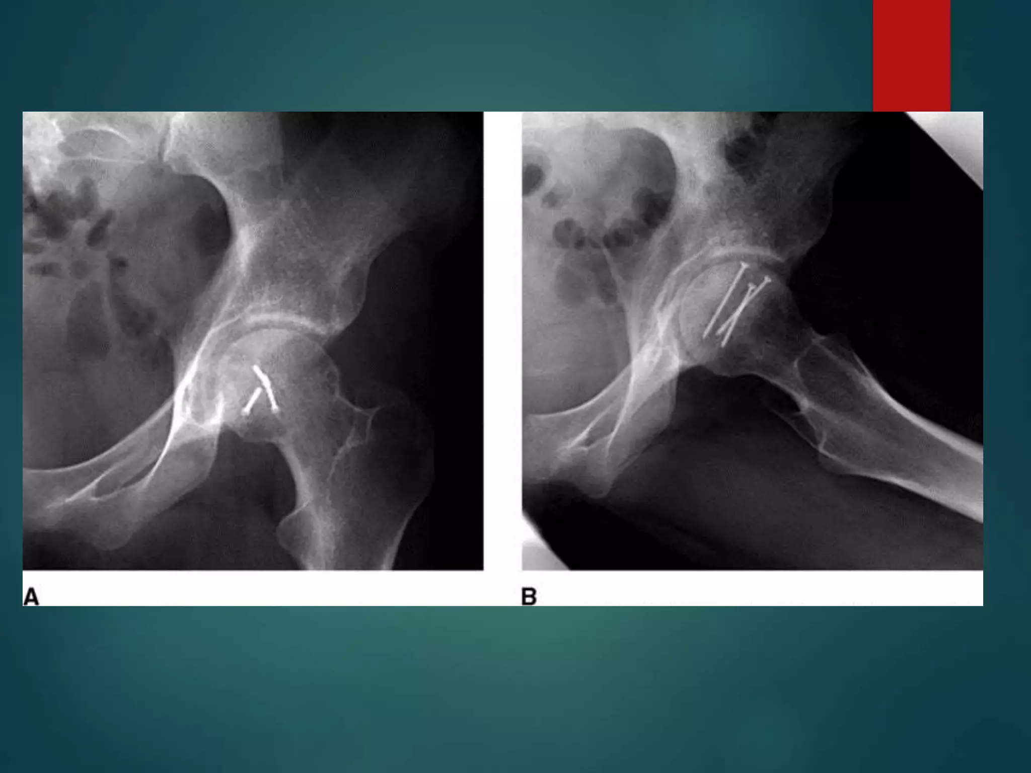 Lower Limb Fractures.pptx