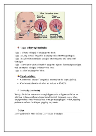 Laryngomalacia