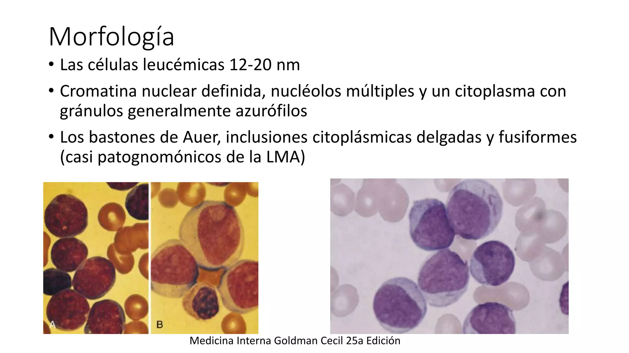 Leucemia mieloide aguda | PPT