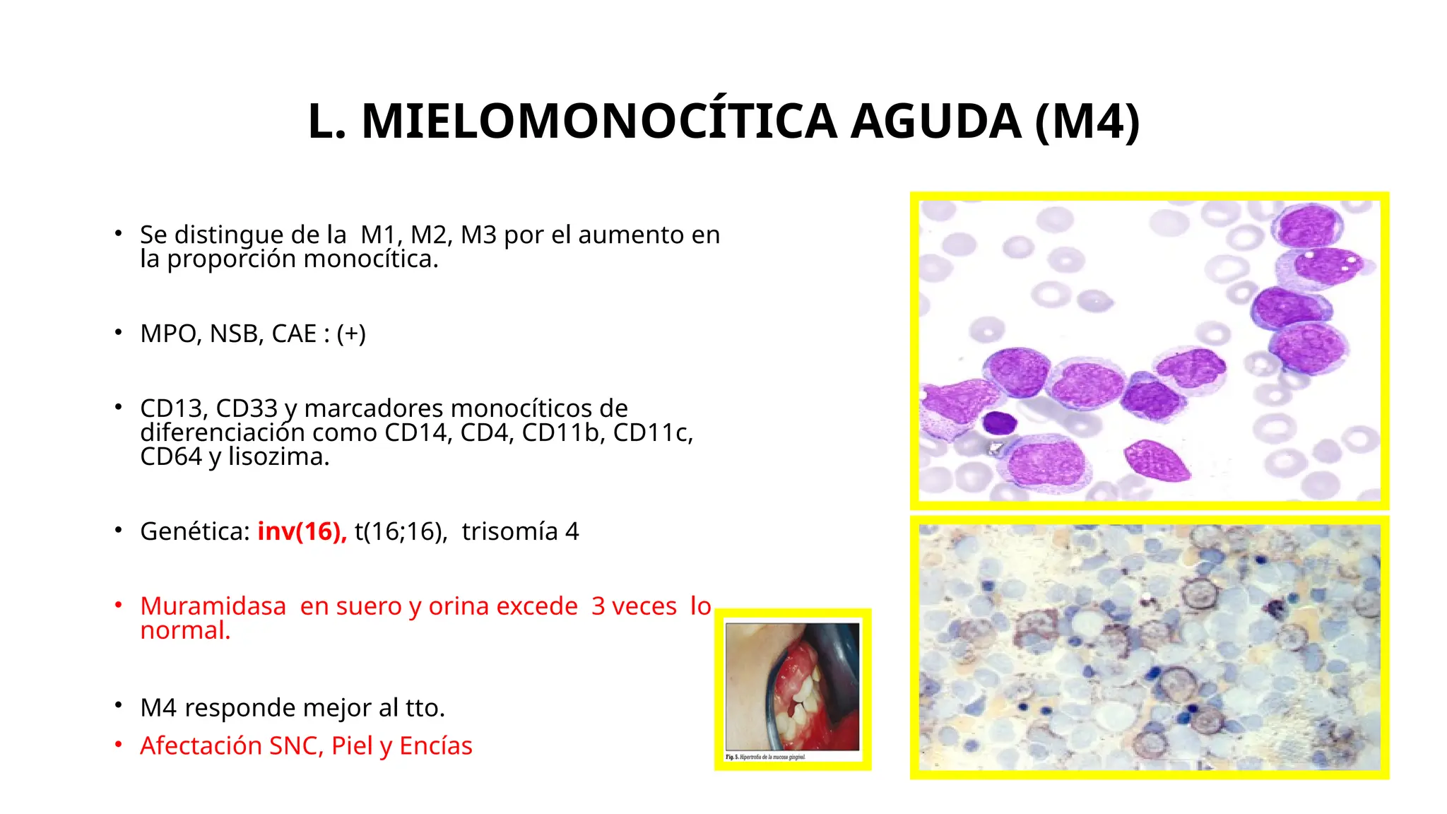 Leucemia Mieloide Aguda abordaje diagnostico | PPTX