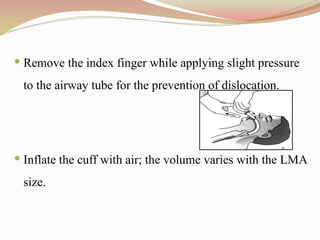 LMA (1).pptx about the tachycardia and the | PPTX