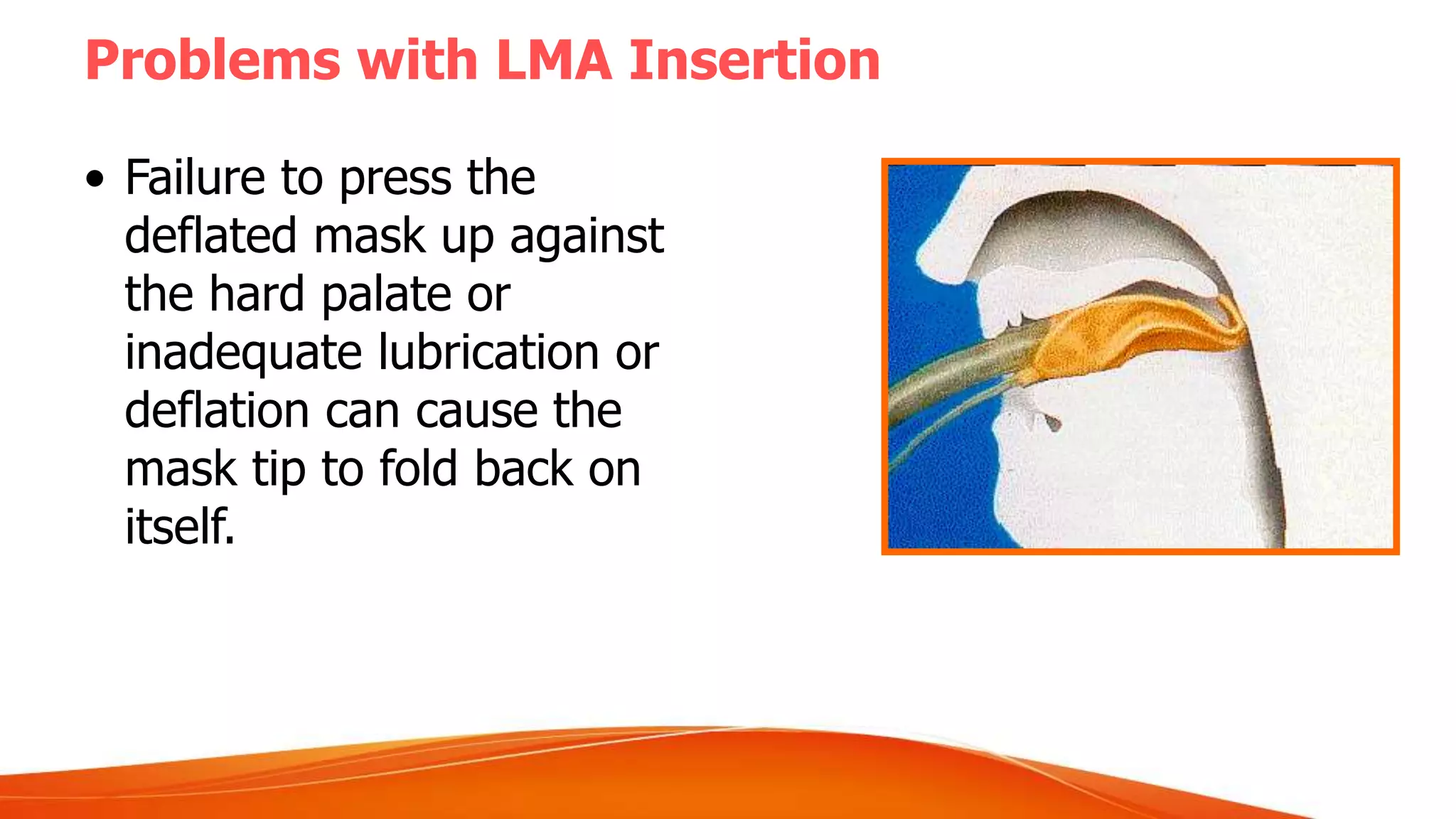 LAYNGEAL MASK AIRWAY | PPTX
