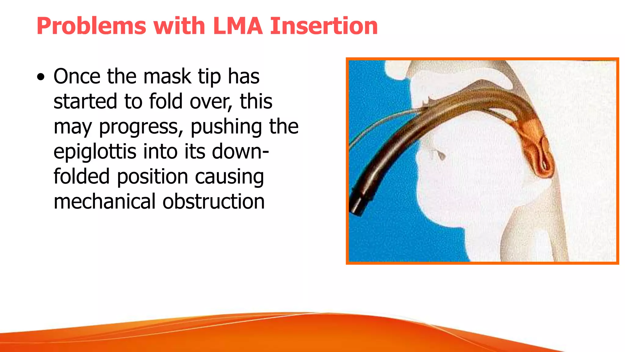 LAYNGEAL MASK AIRWAY | PPTX