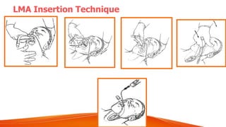 LAYNGEAL MASK AIRWAY | PPTX