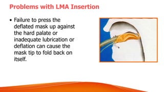 LAYNGEAL MASK AIRWAY | PPTX