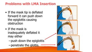 LAYNGEAL MASK AIRWAY | PPTX