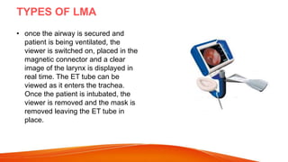 LAYNGEAL MASK AIRWAY | PPTX | Ear, Nose and Throat Conditions ...