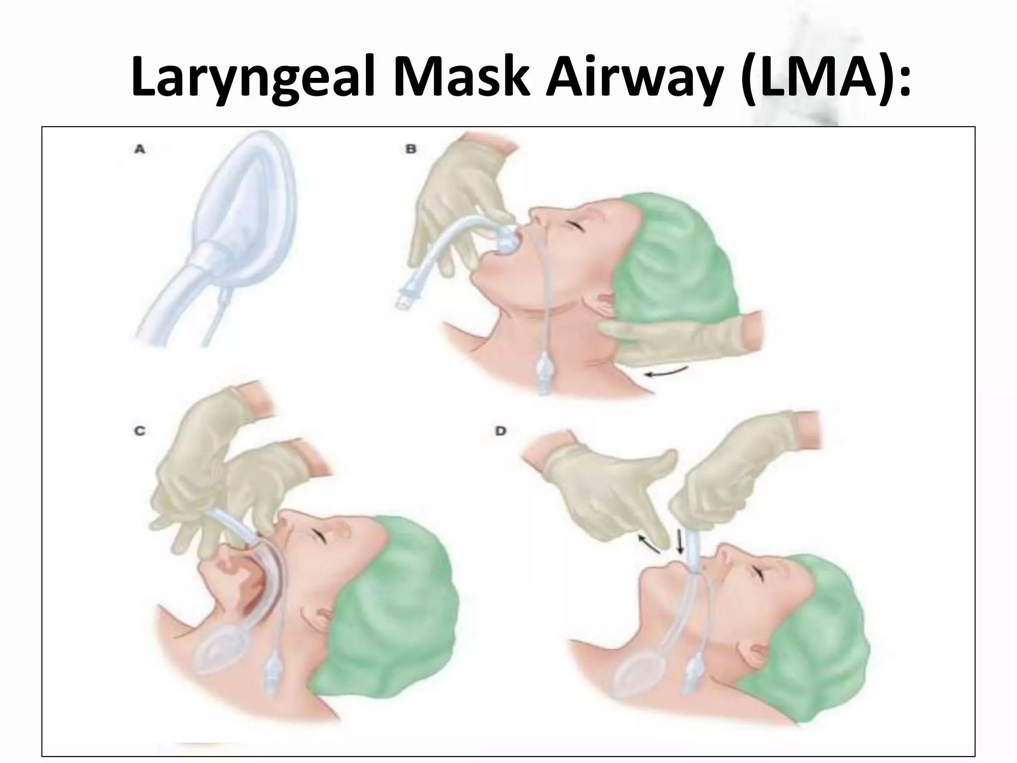 Lma, laryngospasm and pulmonary edema | PPTX | Ear, Nose and Throat ...