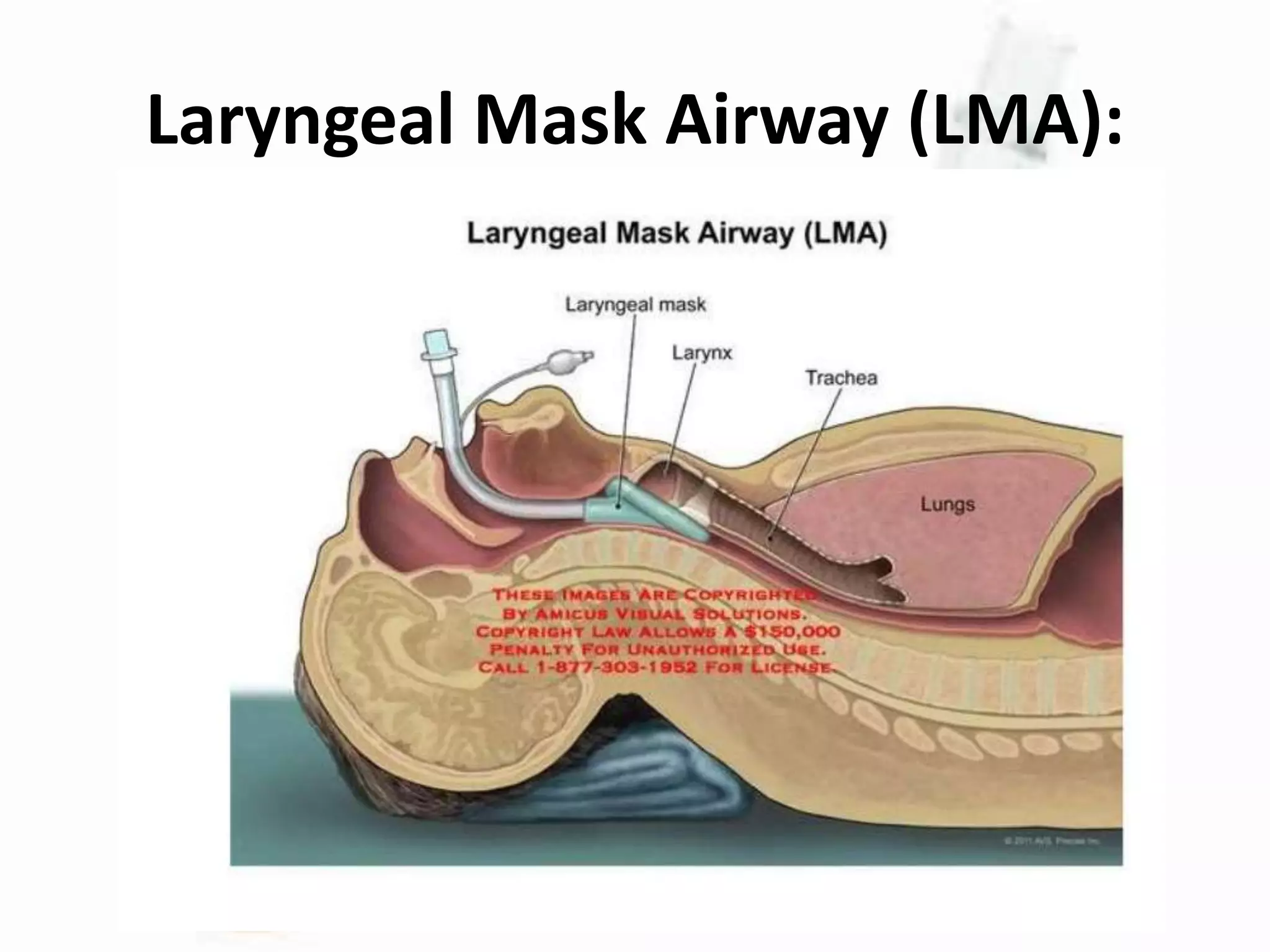 Lma, laryngospasm and pulmonary edema | PPTX | Ear, Nose and Throat ...