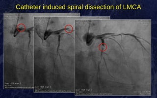 Lmca dissection | PPT