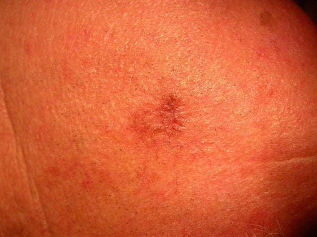 Clinical Case. Pigmented lesion on the cheek | PPT