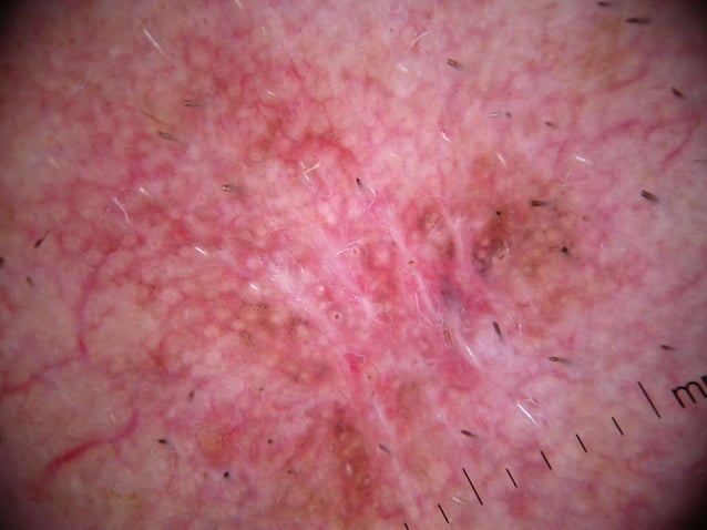 Clinical Case. Pigmented lesion on the cheek | PPT