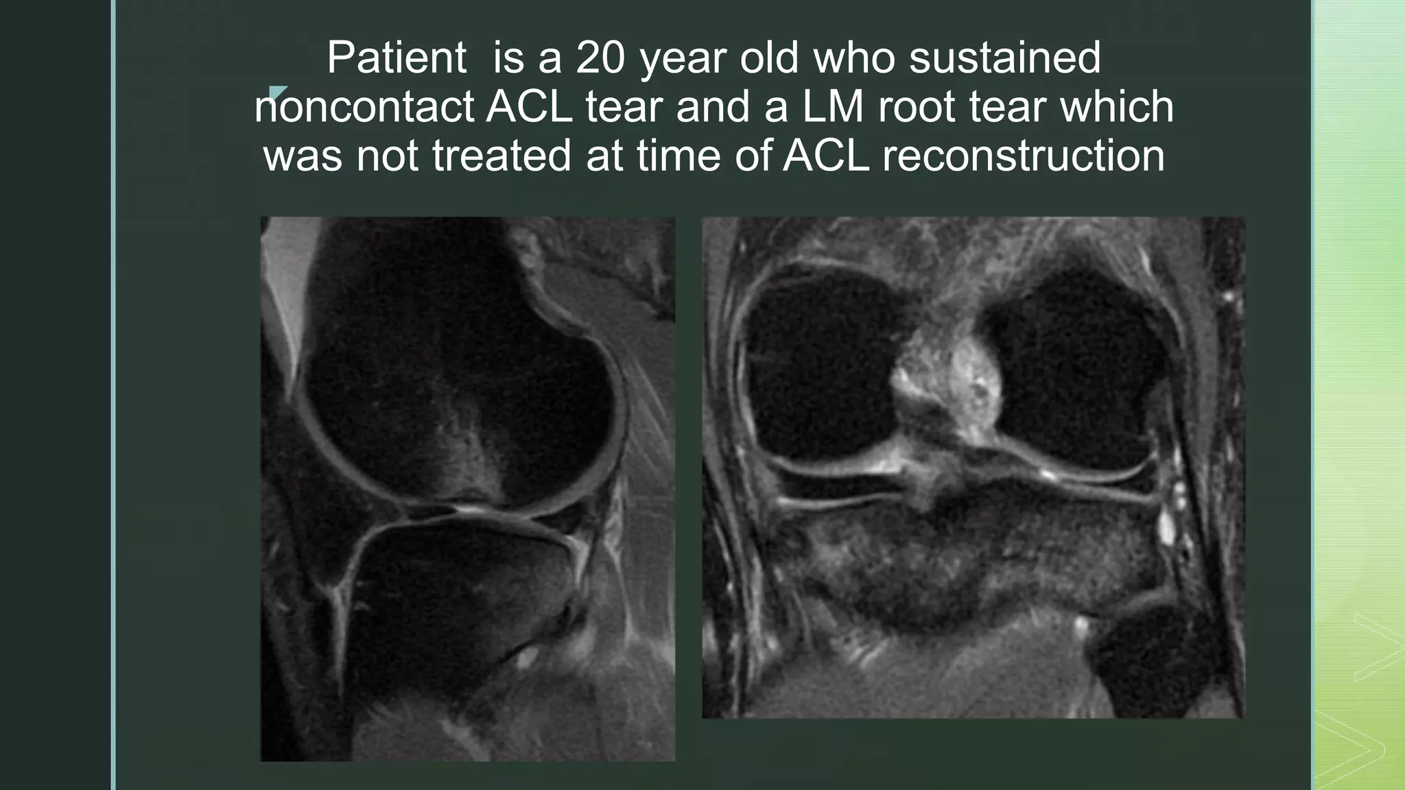 Lateral Meniscus Root Tears - Neglected Cases | PPT