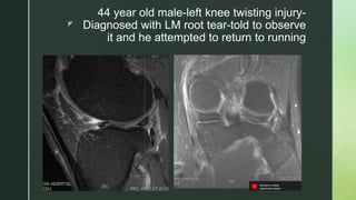 Lateral Meniscus Root Tears - Neglected Cases | PPT