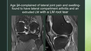 Lateral Meniscus Root Tears - Neglected Cases | PPTX