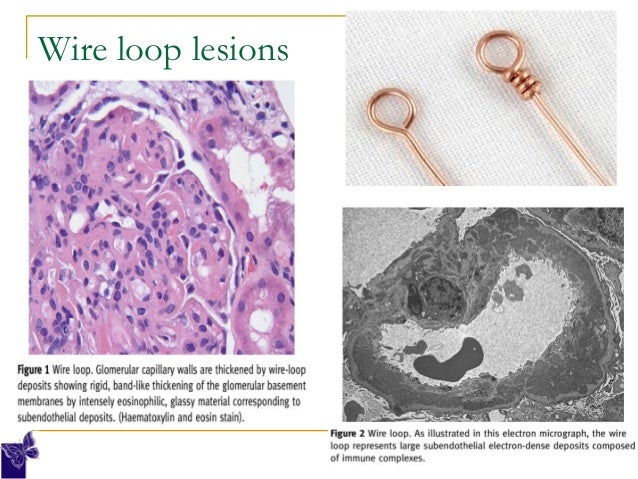 Pathophysiology of lupus nephritis