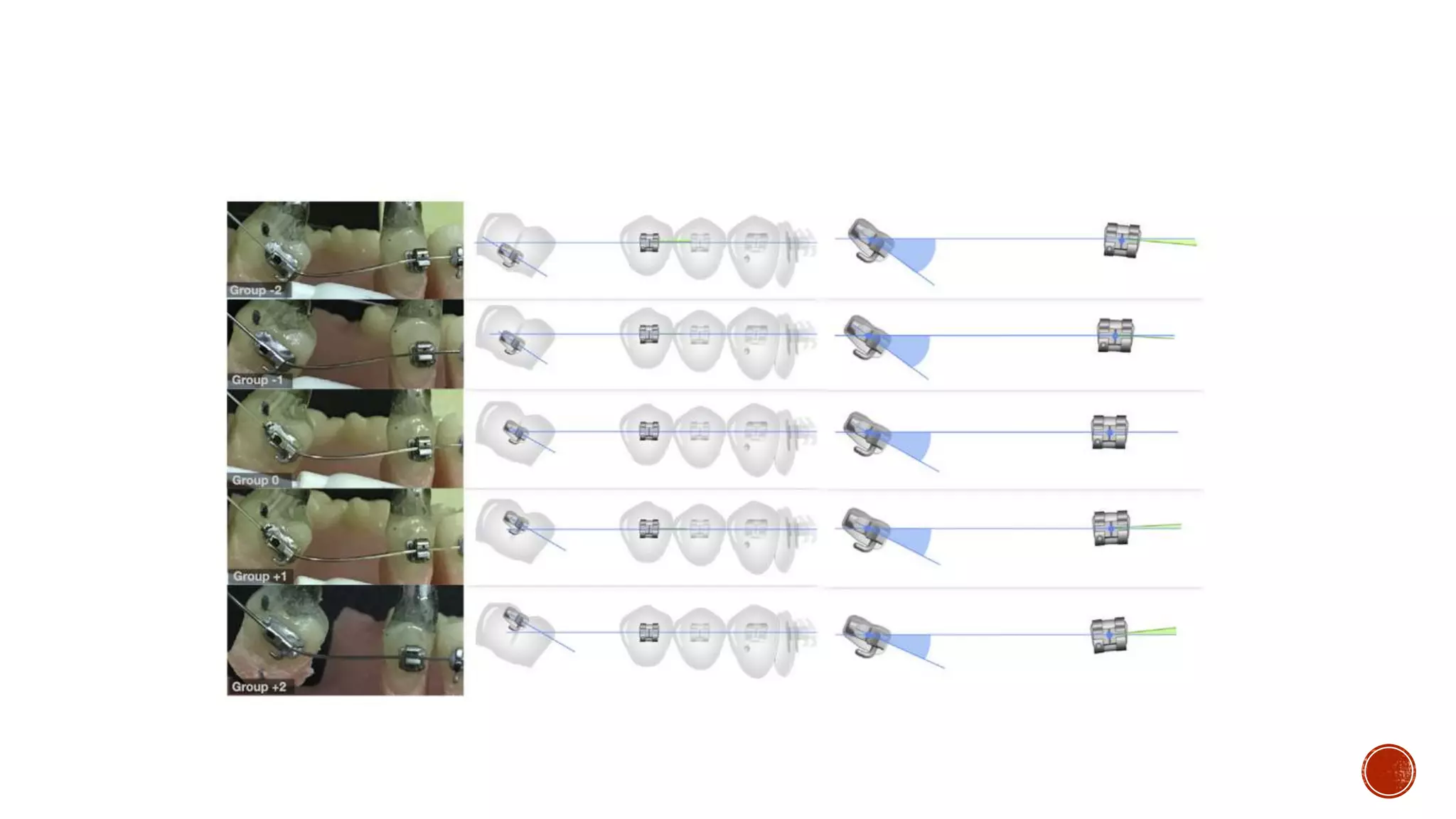 Loads of continuous mechanics for uprighting the second.pptx | Dental ...