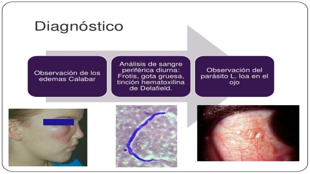 filariasis Loa loa (loiasis)