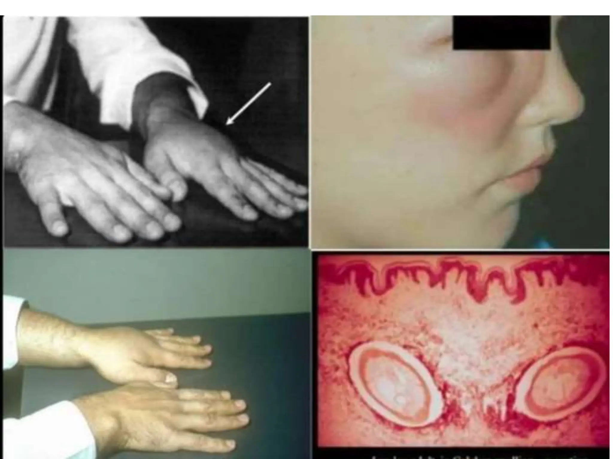 loa loa pptx.pptx africa eye worm loiasis | PPT