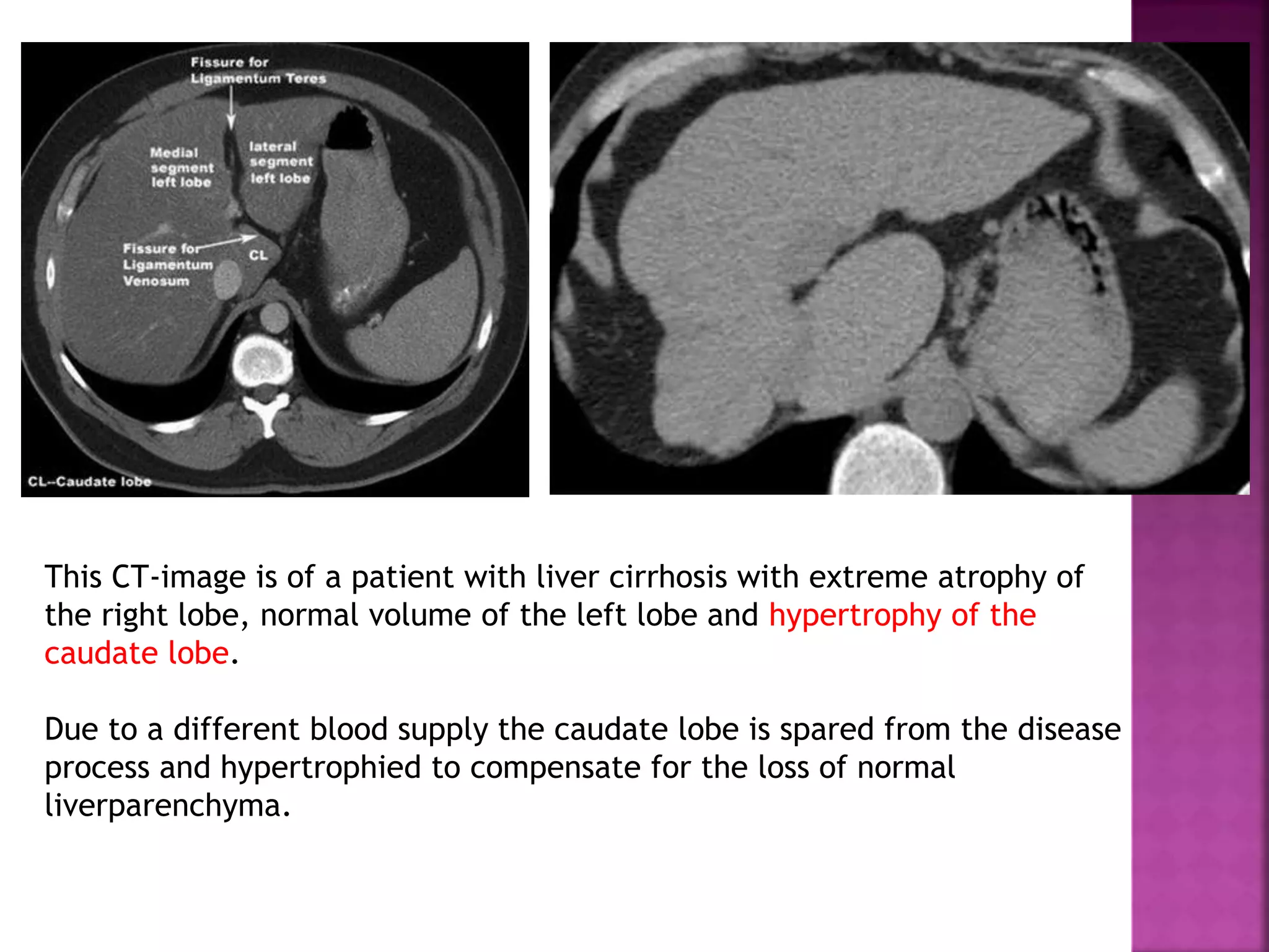lobar anatomy liver radiology.pptx