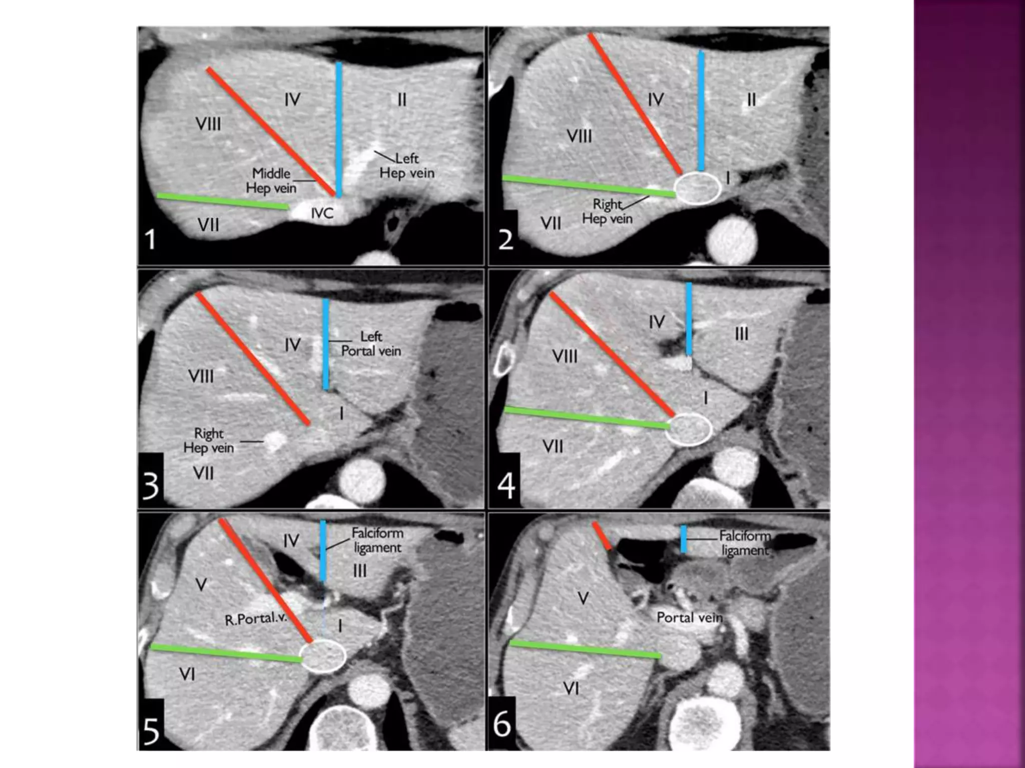 lobar anatomy liver radiology.pptx