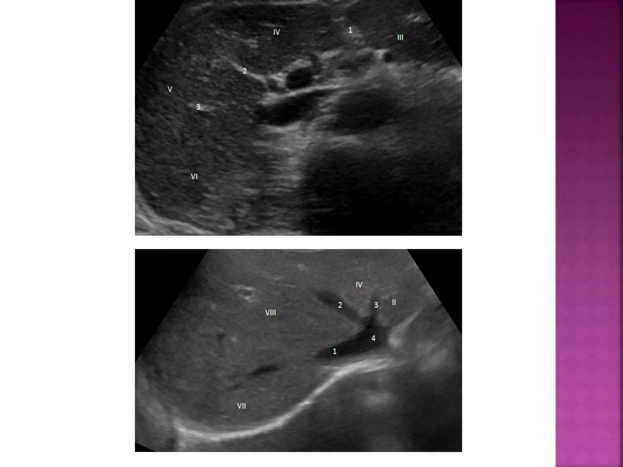 lobar anatomy liver radiology.pptx