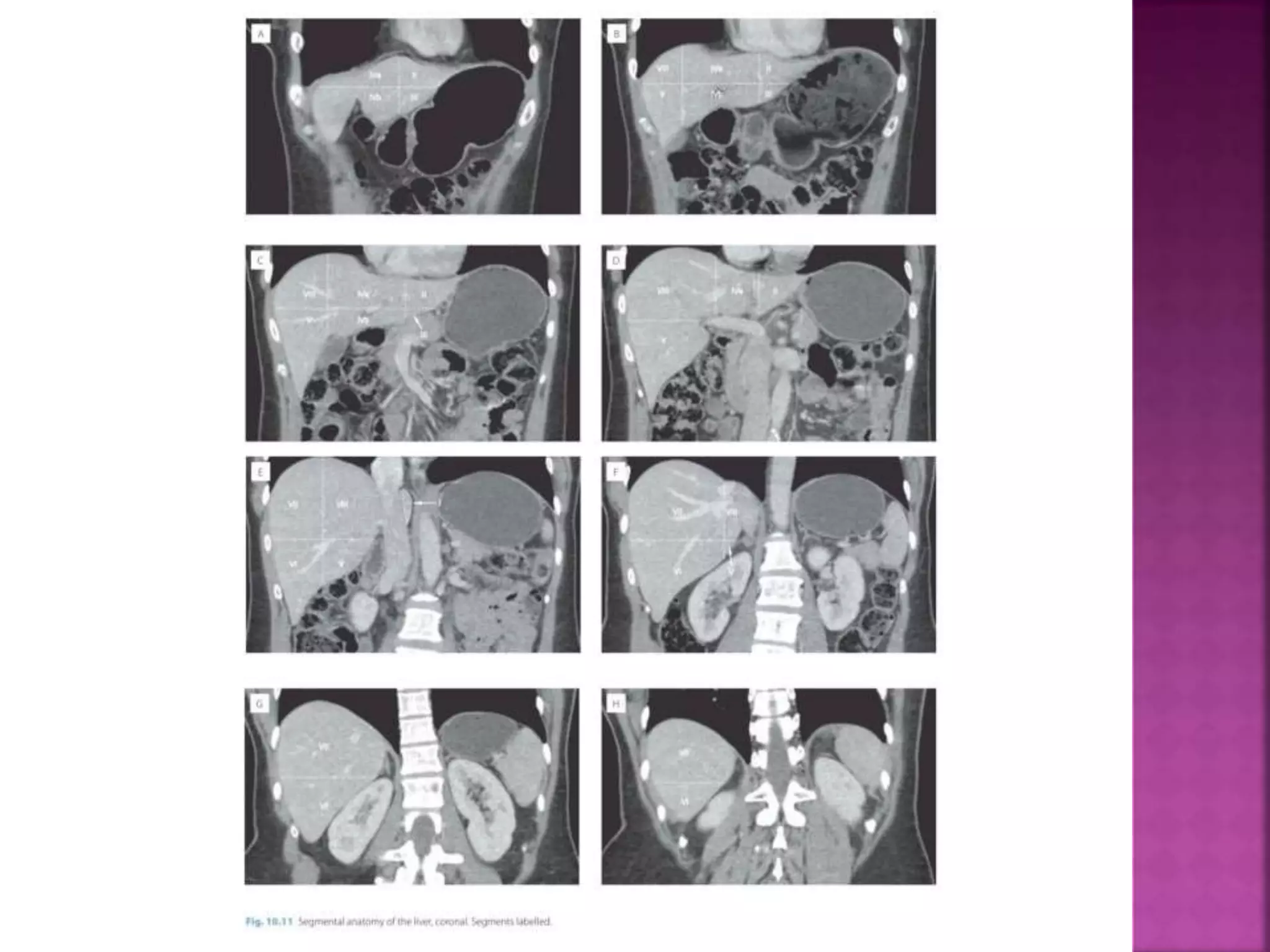 lobar anatomy liver radiology.pptx