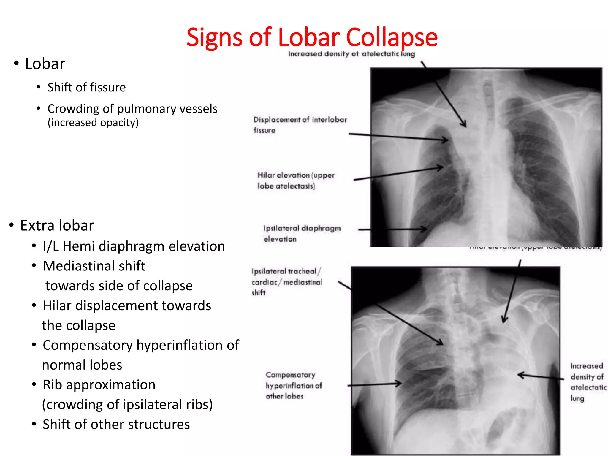 lobar collapse xray.pptx