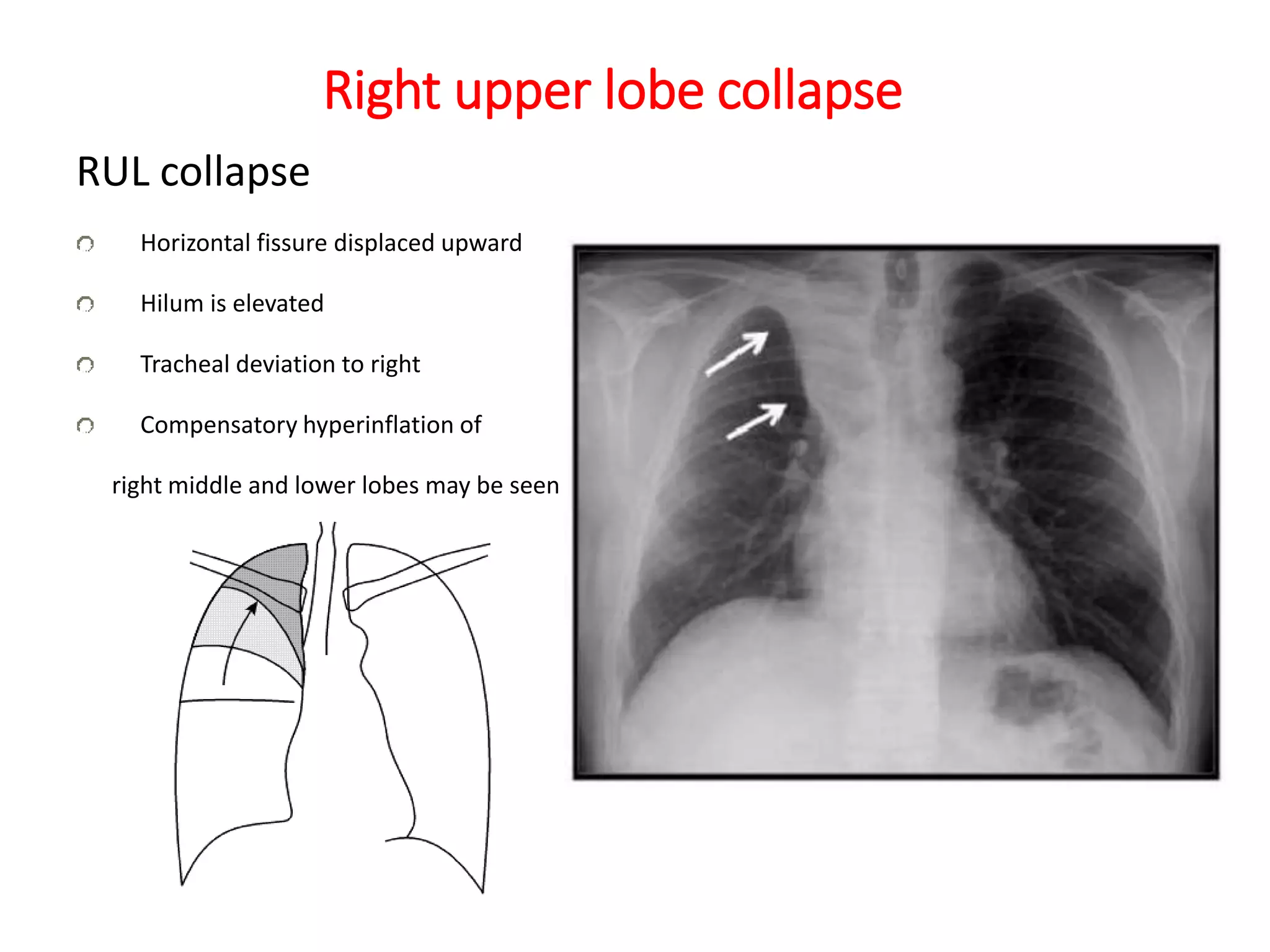 lobar collapse xray.pptx
