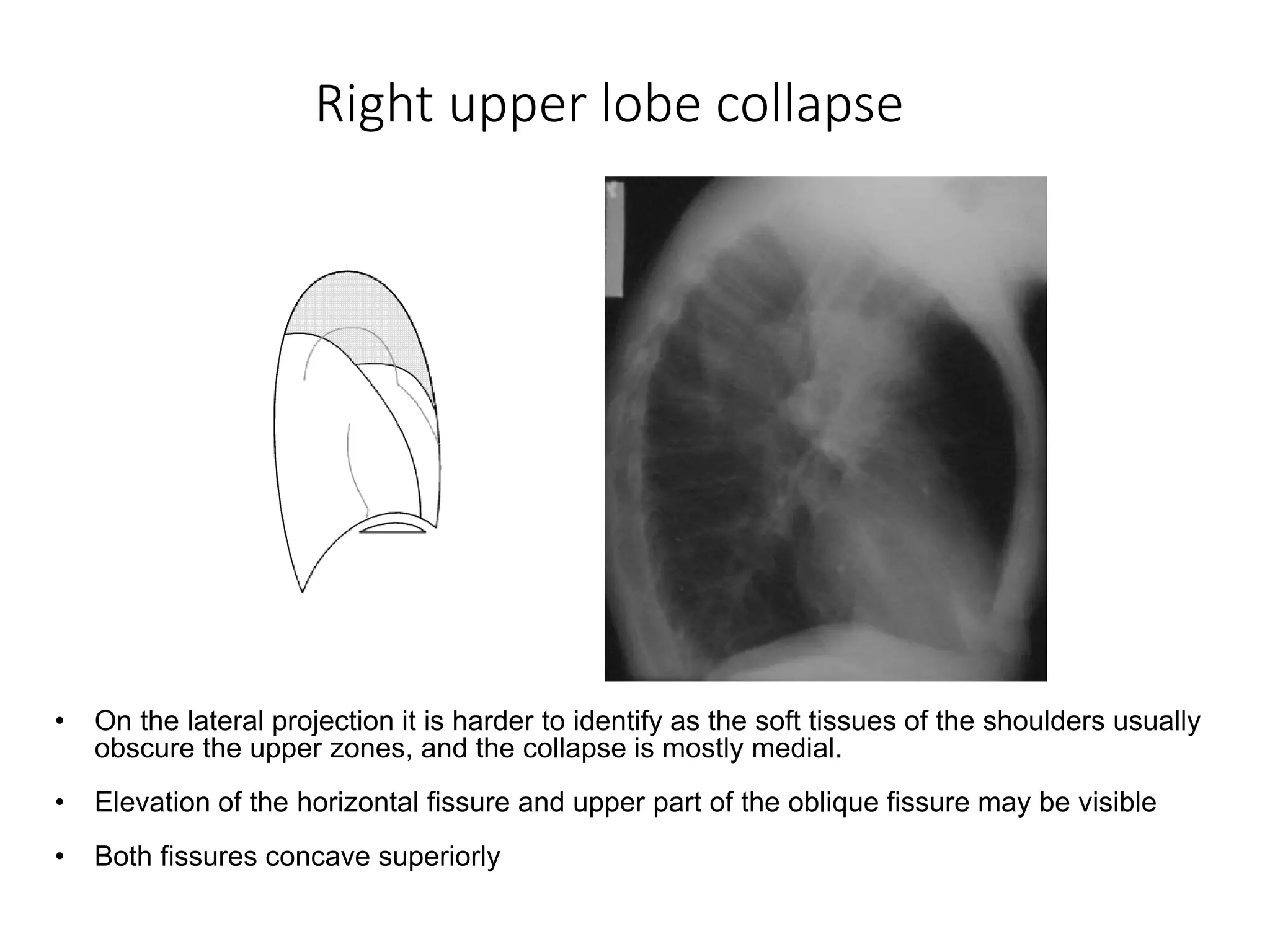 lobar collapse xray.pptx