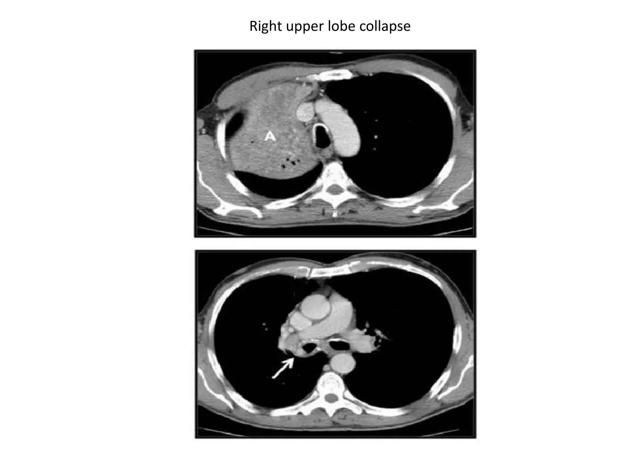 lobar collapse xray.pptx