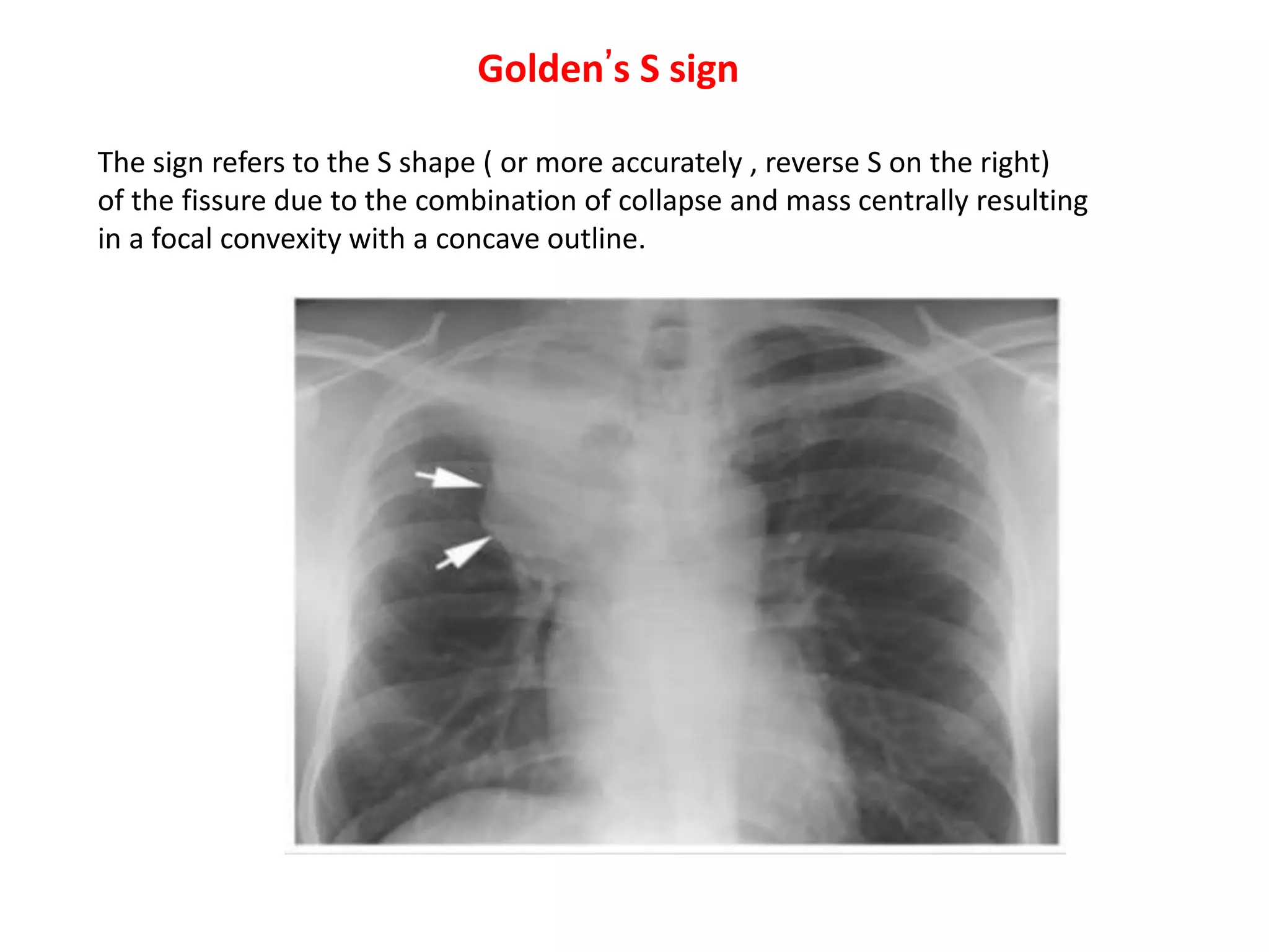 lobar collapse xray.pptx