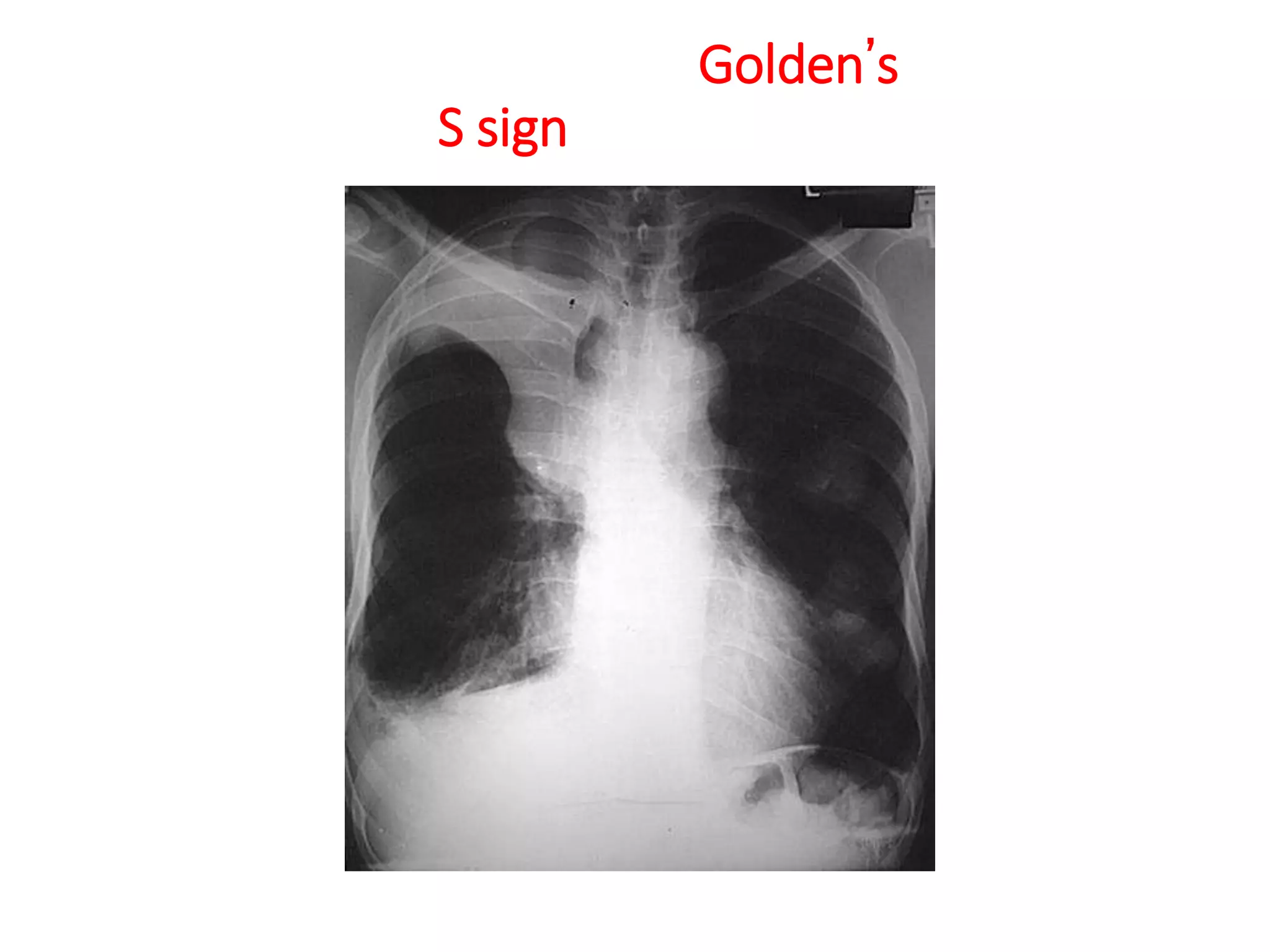 lobar collapse xray.pptx
