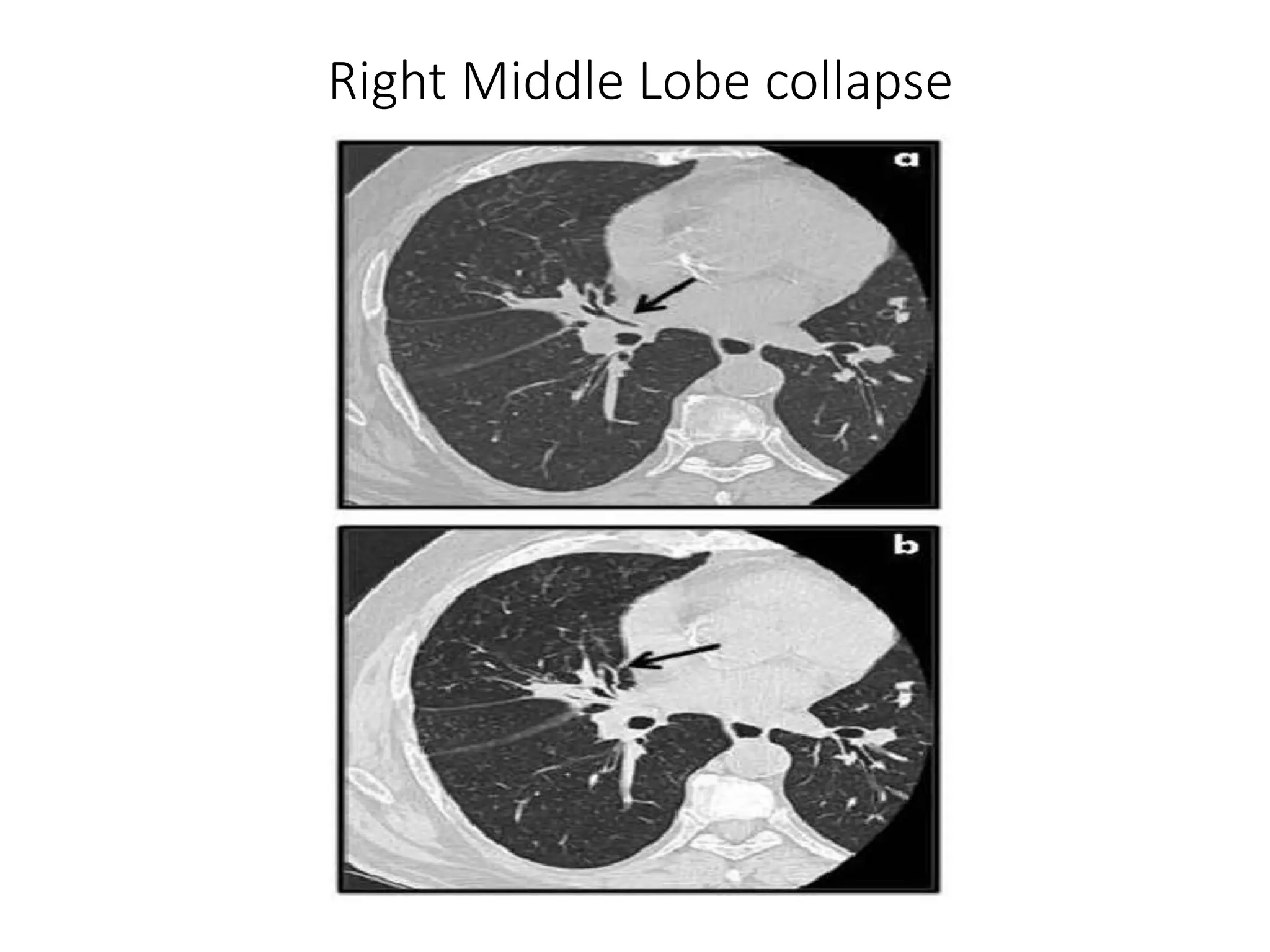 lobar collapse xray.pptx