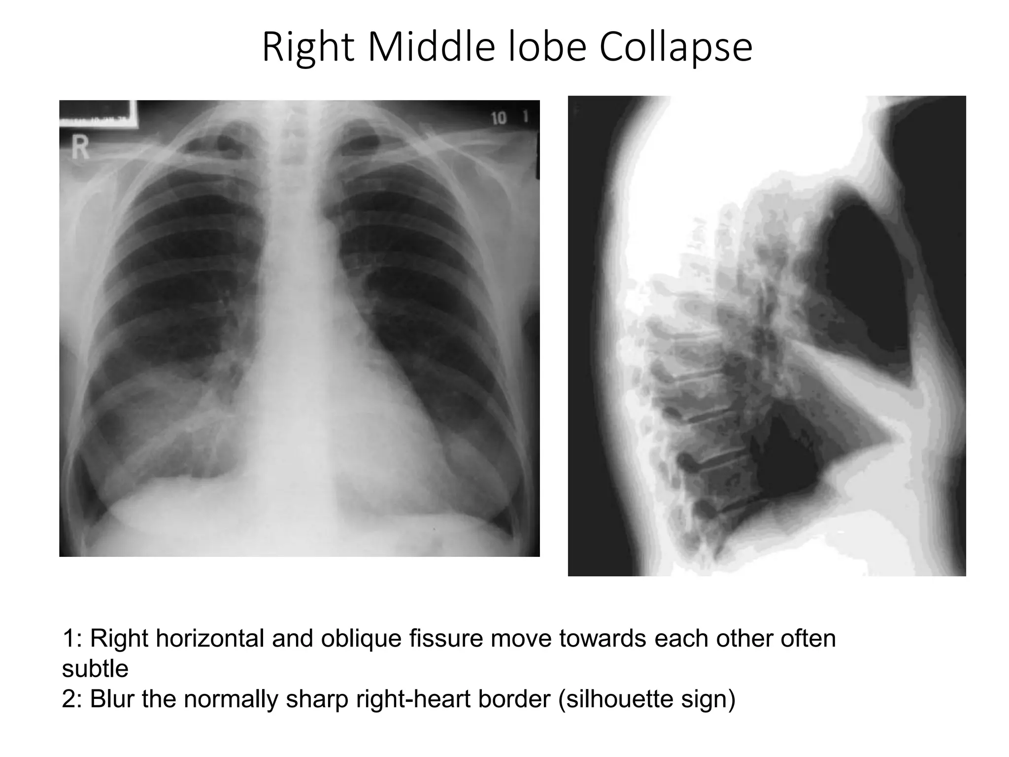 lobar collapse xray.pptx